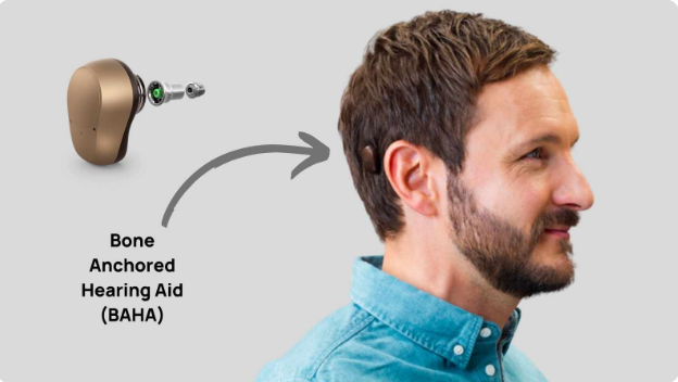 Bone Anchored Hearing Aids – Advanced Hearing Solutions – Vivtone